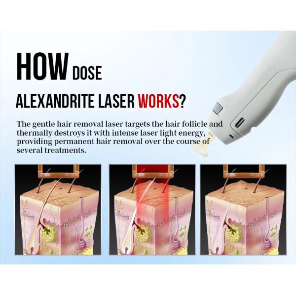 Experience the Best Skin Rejuvenation Results with 755nm Alexandrite ...